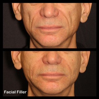 Facial Fillers for Men | Dr. Diane Walder, Miami