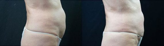 Before and after Archive - Cosmetic Dermatology | Miami, FL